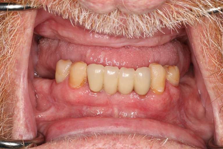 Brentwood TN Dentist | Smile Gallery | Implant Dentures Brentwood